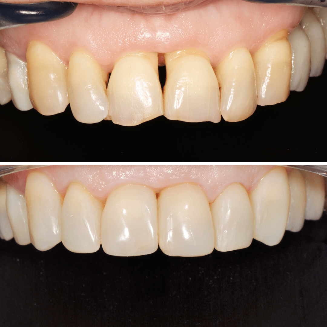 Tooth Coloured Fillings - Hurst Farm Dental